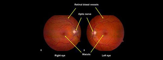 ARMD Age Related Macular Degeneration AMD Dry Wet ARMD AntiVEGF 